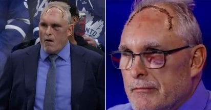 Craig Berube shares the truth behind his gruesome head injury